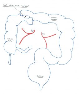 Colectomies - chirurgie du colon - Bordeaux Chirurgie Viscérale et ...