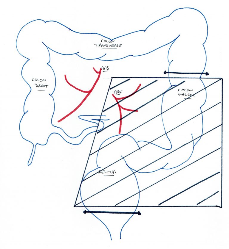 Résections rectales - chirurgie du rectum - Bordeaux Chirurgie ...
