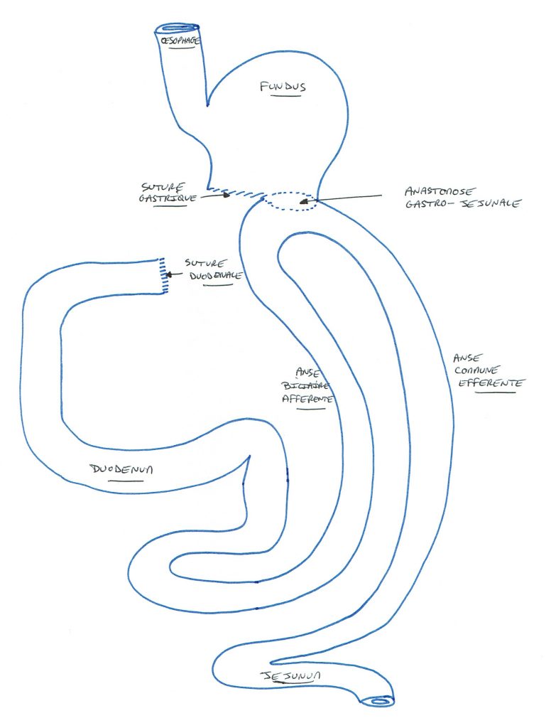 Gastrectomies - Bordeaux Chirurgie Viscérale et Digestive
